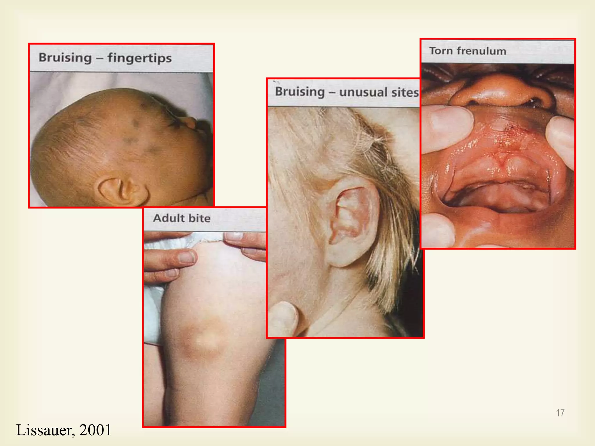 Pengkajian Kekerasan Pada Anak.ppt