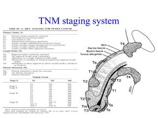 Penile Cancer Staging