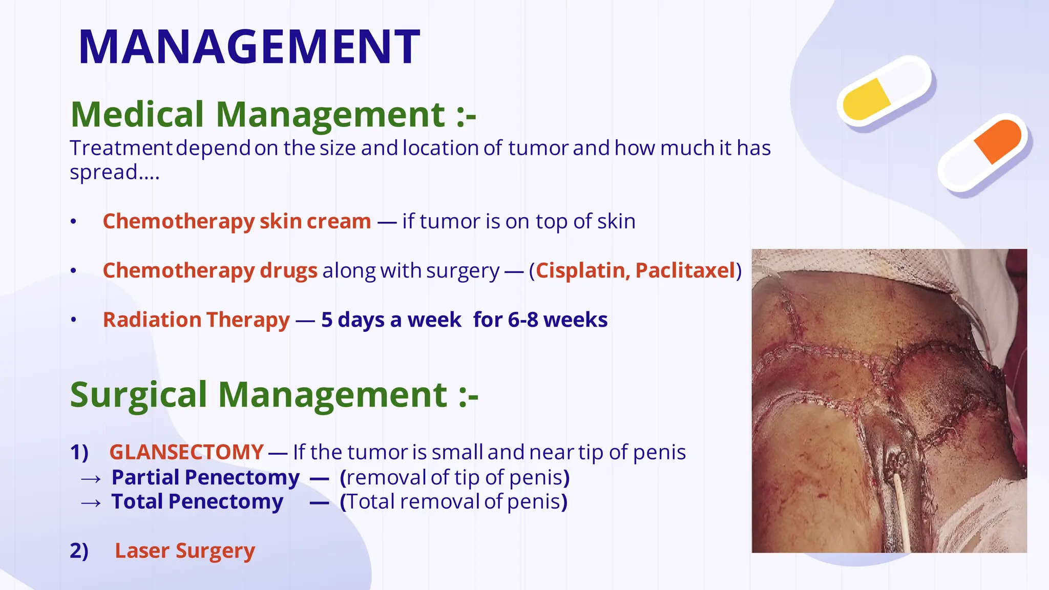Penile Carcinoma by Ashutosh Rao 2.pdf