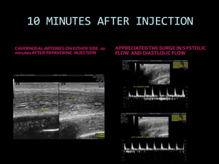 Penile doppler a review | PPTX