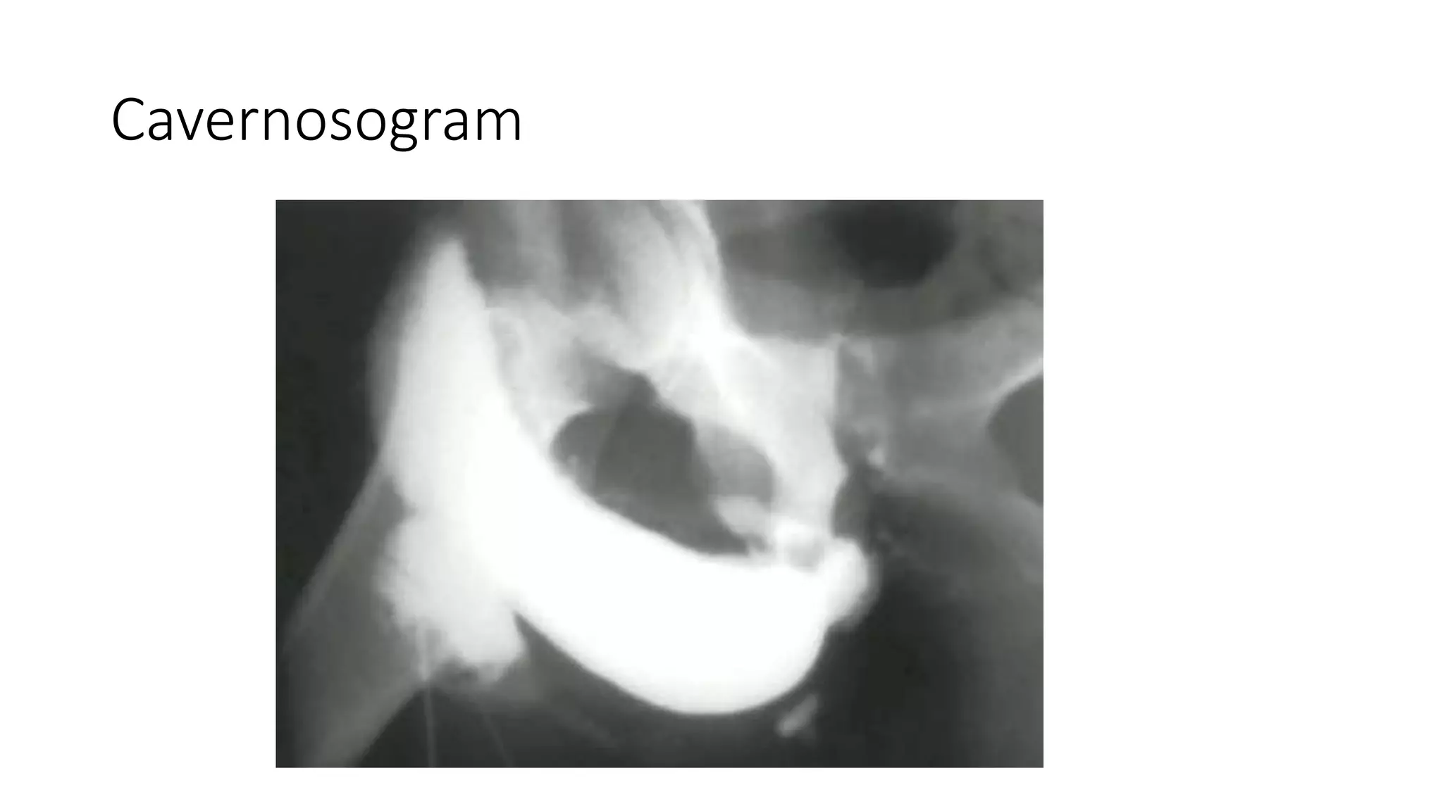 Penile fracture.pptx