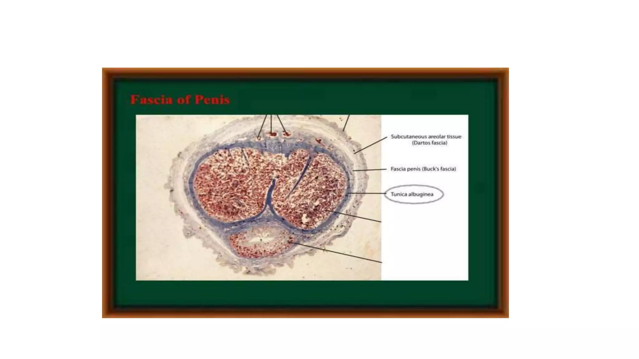 PENILE FRACTURE.pptx