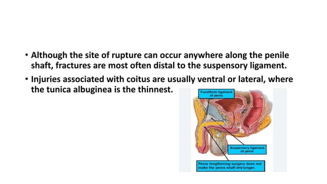 PENILE FRACTURE.pptx | Sexual Conditions | Sexual Health