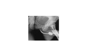 PENILE FRACTURE.pptx