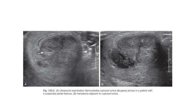 PENILE FRACTURE.pptx | Sexual Conditions | Sexual Health
