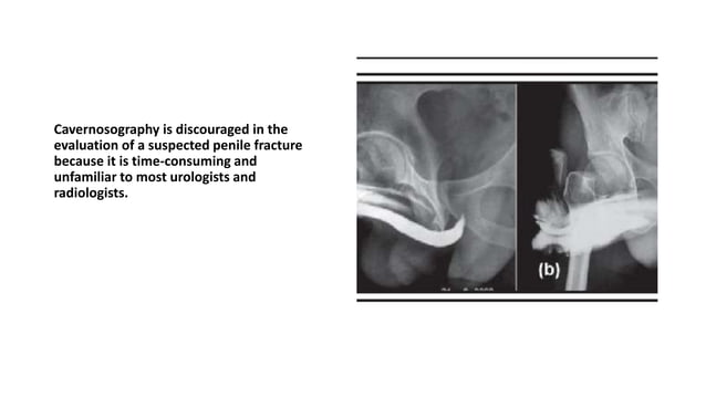 PENILE FRACTURE.pptx | Sexual Conditions | Sexual Health