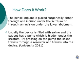 Penile implants powerpoint | PPT
