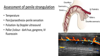 Penile strangulation | PPTX