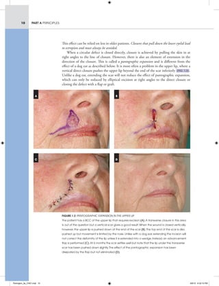 Local Flap Reconstruction - sample chapter | PDF
