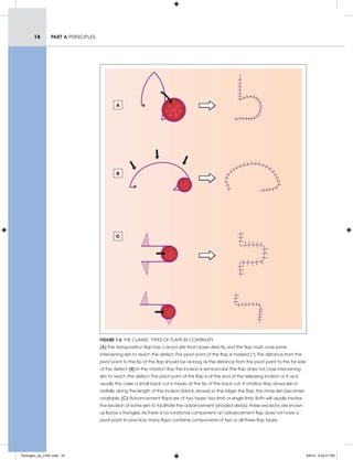 Local Flap Reconstruction - sample chapter | PDF