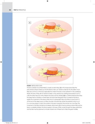 Local Flap Reconstruction - sample chapter | PDF