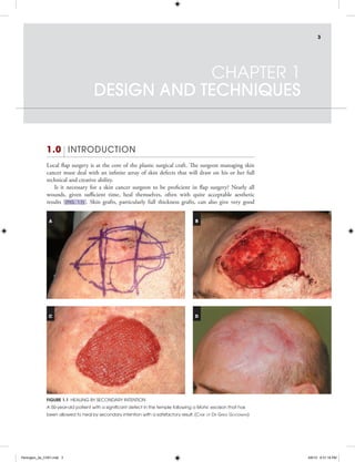 Local Flap Reconstruction - sample chapter | PDF