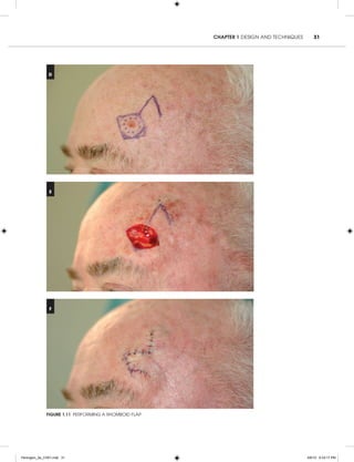 Local Flap Reconstruction - sample chapter | PDF