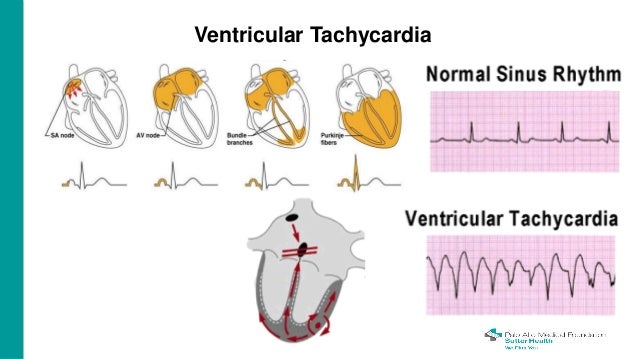 Ventricular Arrhythmias: Ablating Our Way Out of Cardiomyopathy and S…