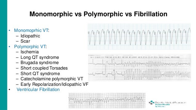 Difference Between Monomorphic And Polymorphic Ventricular Tachycardia