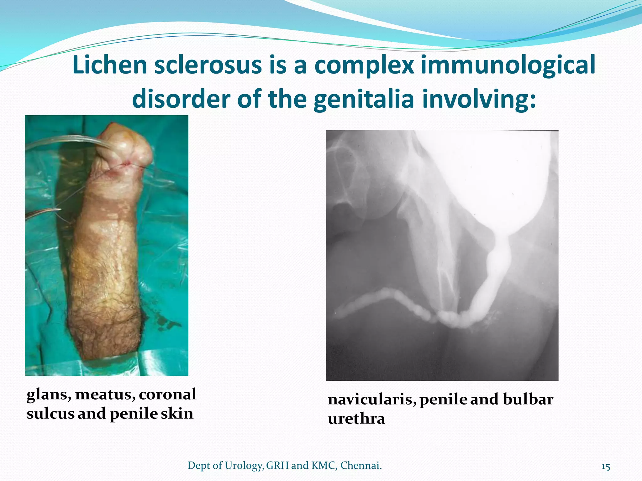 Penis: BALANITIS XEROTICA OBLITARANS(bxo) | PDF