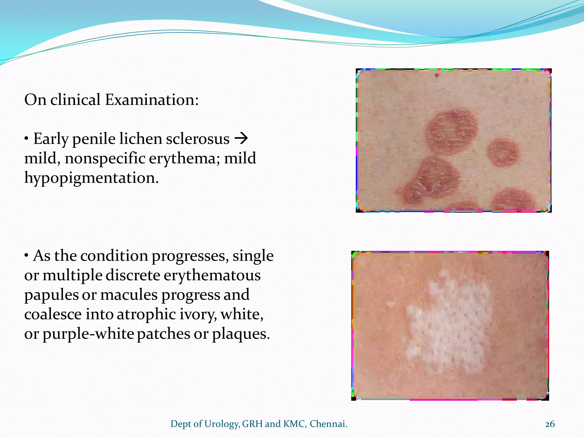 Penis: BALANITIS XEROTICA OBLITARANS(bxo) | PDF