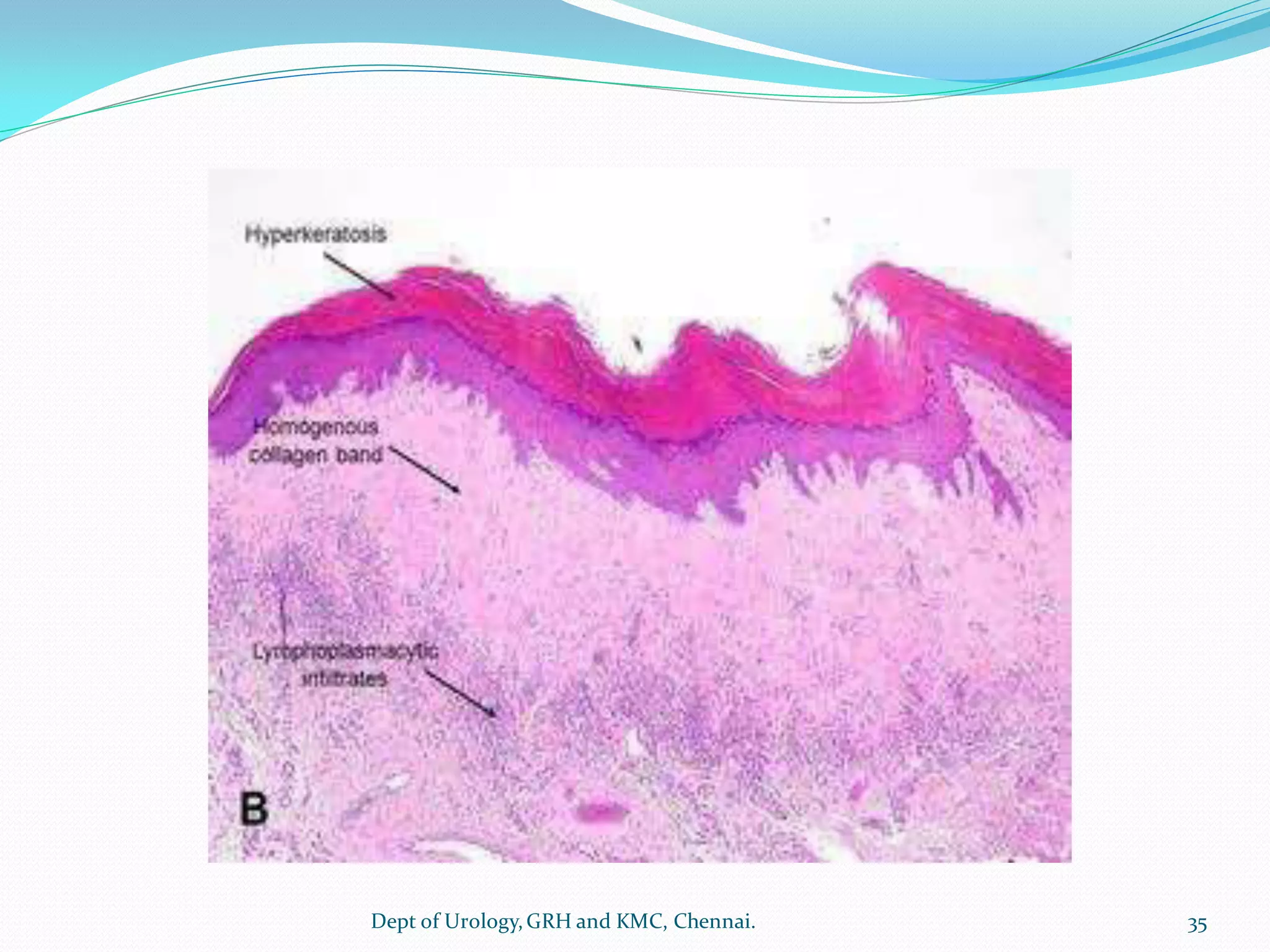 Penis: BALANITIS XEROTICA OBLITARANS(bxo) | PDF