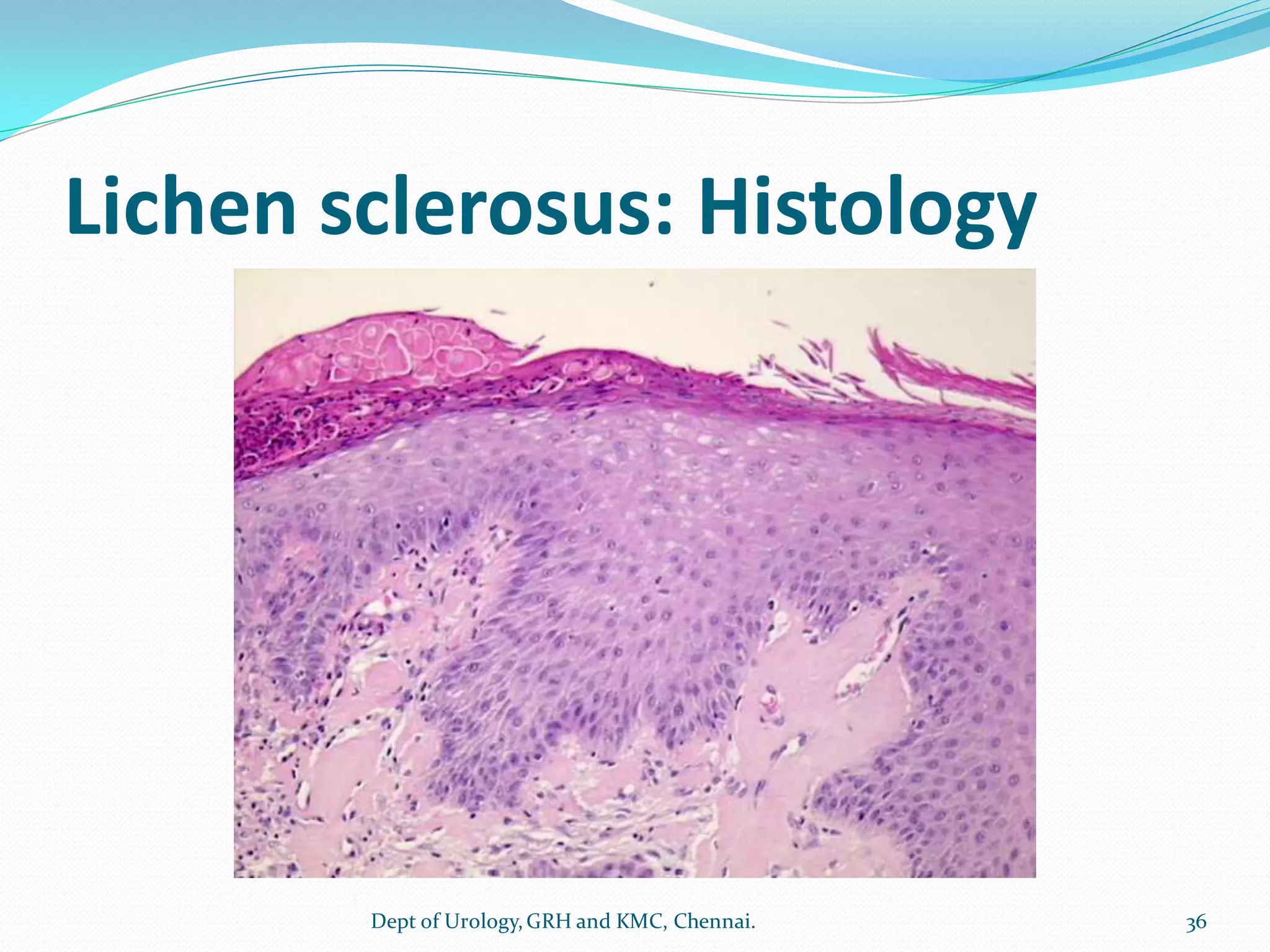 Penis: BALANITIS XEROTICA OBLITARANS(bxo) | PDF