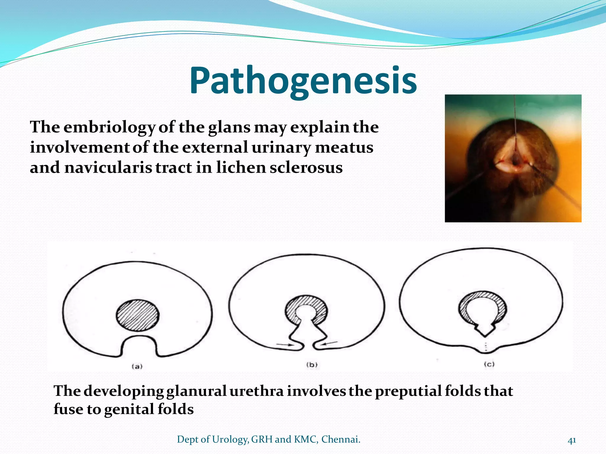 Penis: BALANITIS XEROTICA OBLITARANS(bxo) | PDF