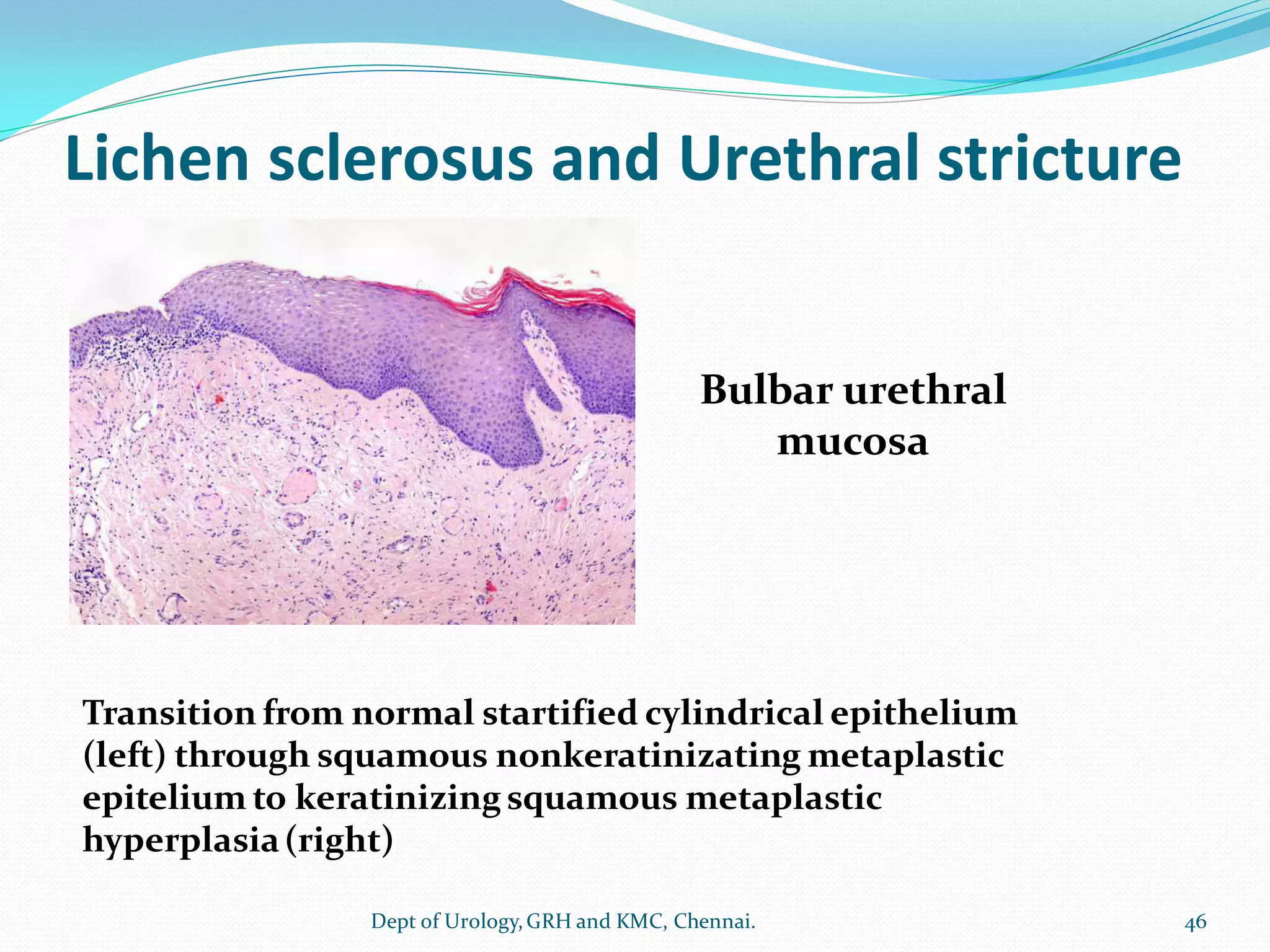 Penis: BALANITIS XEROTICA OBLITARANS(bxo) | PDF