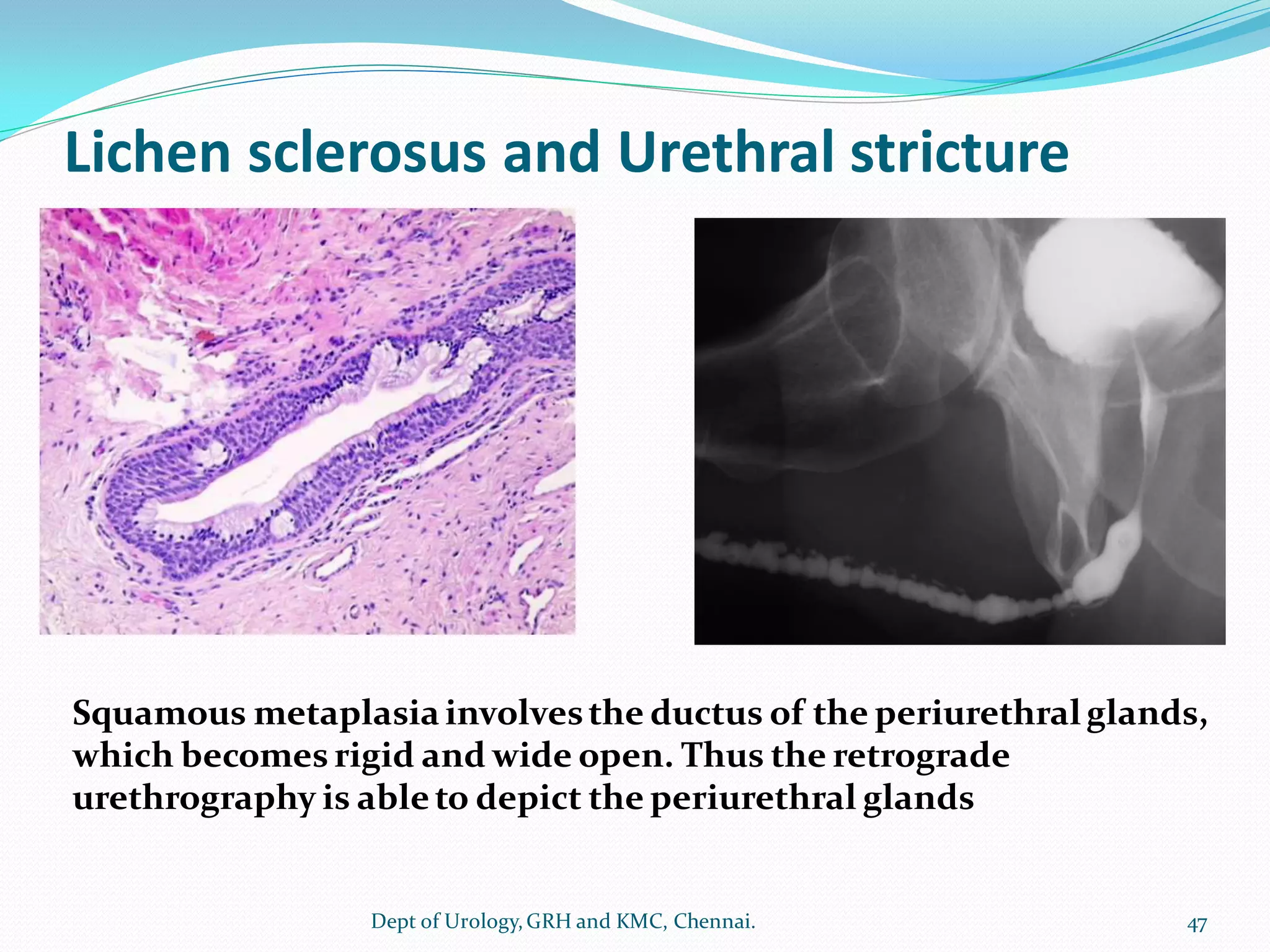 Penis: BALANITIS XEROTICA OBLITARANS(bxo) | PDF