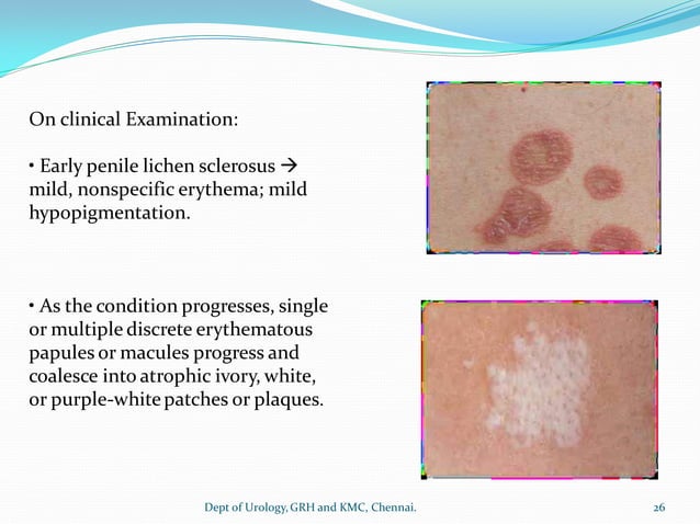 Penis: BALANITIS XEROTICA OBLITARANS(bxo) | PDF