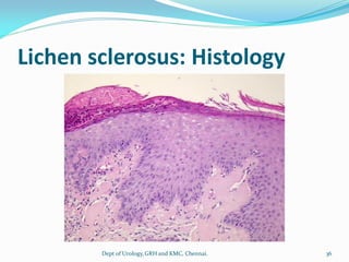 Balanitis Xerotica Obliterans Histology