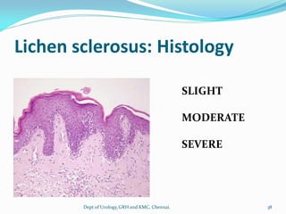 Balanitis Xerotica Obliterans Histology