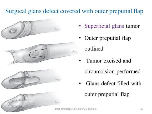 Penis carcinoma- overview | PDF | Sexual Conditions | Sexual Health