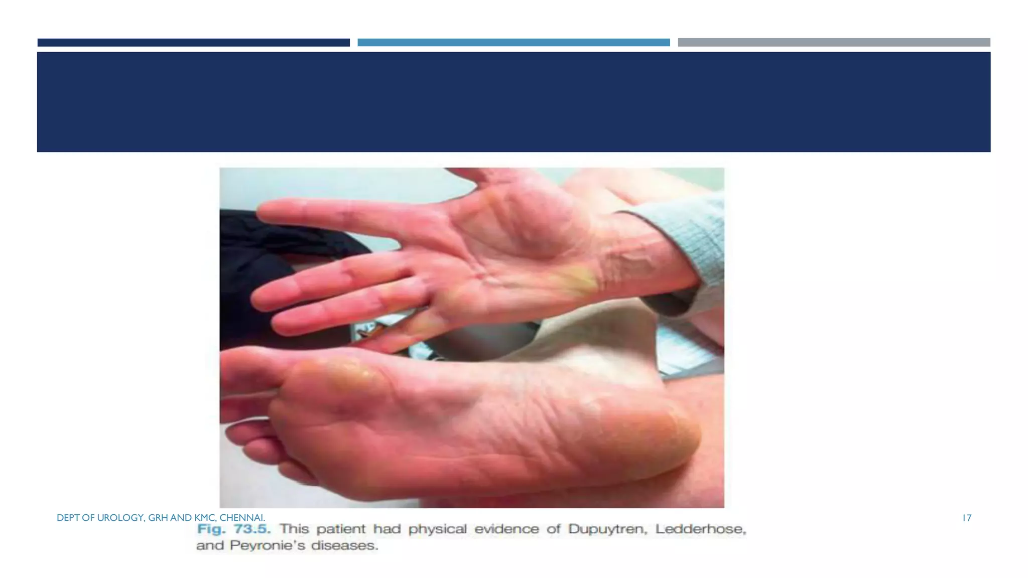 Penis peyronies disease | PDF