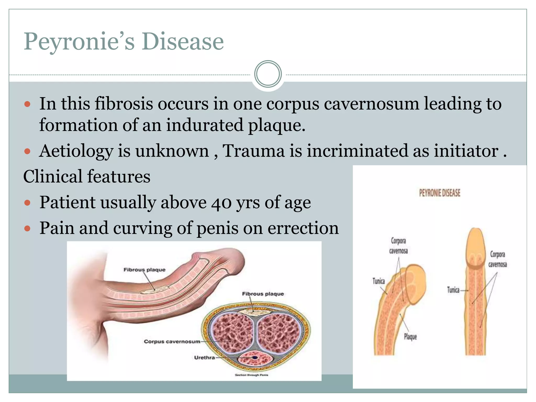 Penis & disorders | PPTX