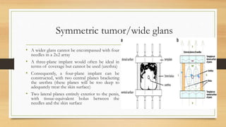Penis journal club | PPT