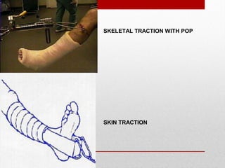 PENJAGAAN PESAKIT MENGALAMI KEPATAHAN | PPT