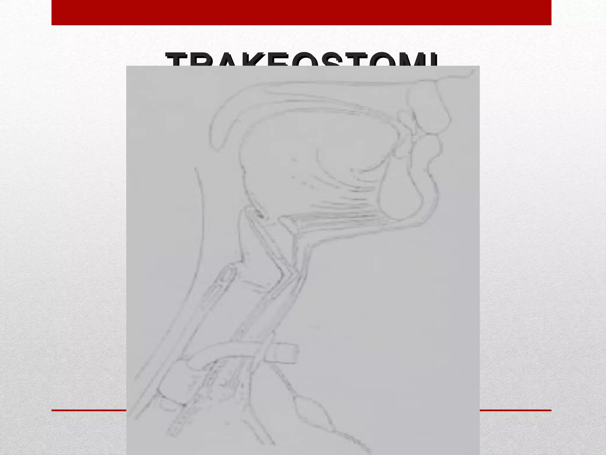 Penjagaan trakeostomi | PPT
