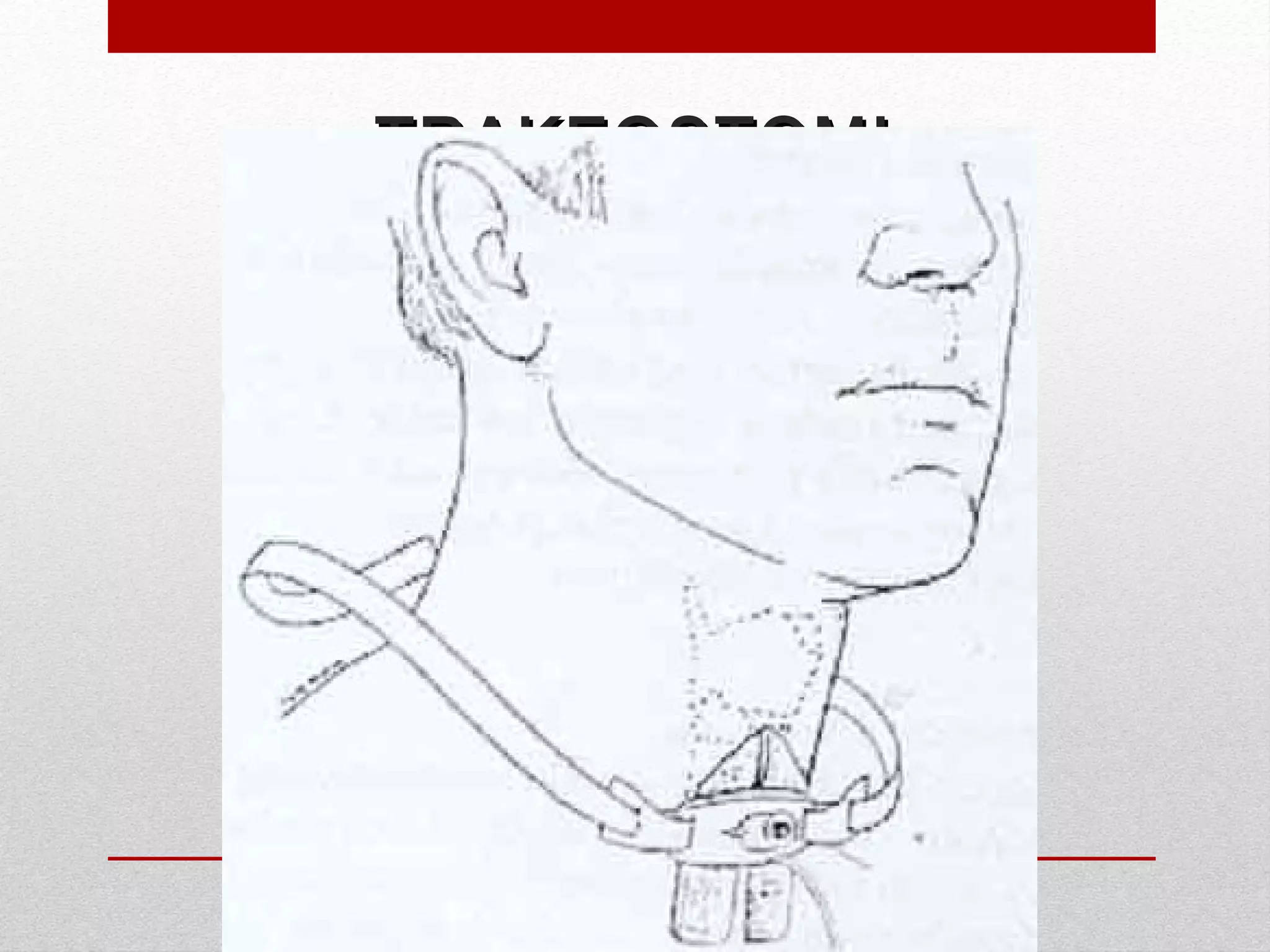 Penjagaan trakeostomi | PPT