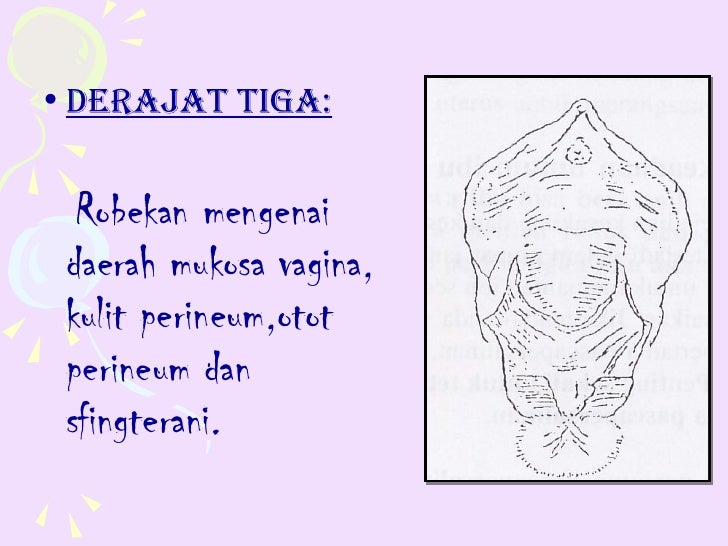 Haecting for Perineum Laceration