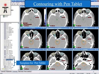 Pen tablet vs mouse for Contouring OAR and targets | PPTX