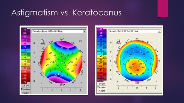 Pentacam | PDF | Eye and Vision Conditions | Diseases and Conditions