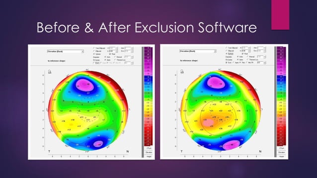 Pentacam | PDF | Eye and Vision Conditions | Diseases and Conditions