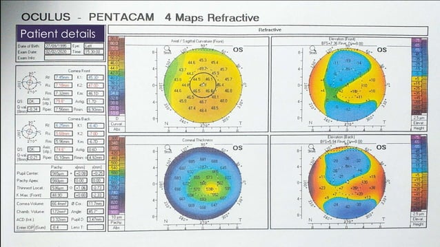 Pentacam | PDF | Eye and Vision Conditions | Diseases and Conditions