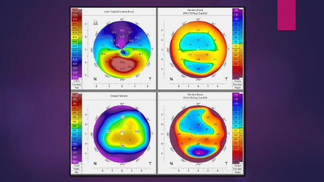 Pentacam | PDF | Eye and Vision Conditions | Diseases and Conditions