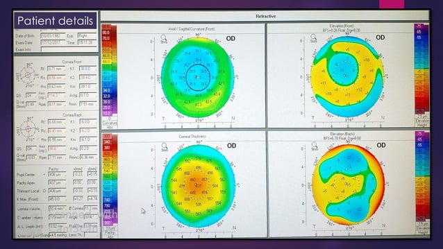 Pentacam | PDF | Eye and Vision Conditions | Diseases and Conditions