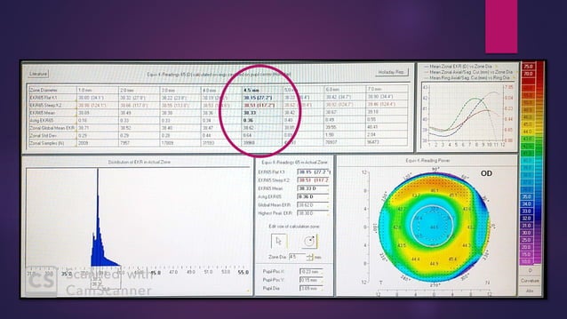 Pentacam | PDF | Eye and Vision Conditions | Diseases and Conditions