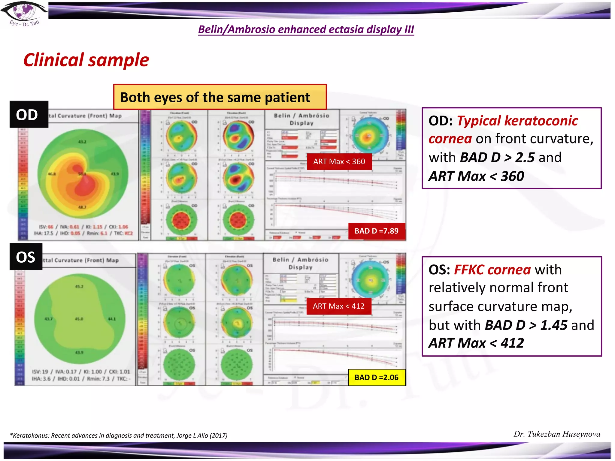 "Pentacam" from the beginning | PDF