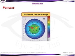 "Pentacam" from the beginning | PDF