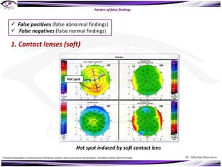"Pentacam" from the beginning | PDF