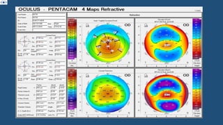 PENTACAM . PRINCIPLE , INTERPRETATION MADE EASY | PPTX