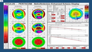 PENTACAM . PRINCIPLE , INTERPRETATION MADE EASY | PPTX