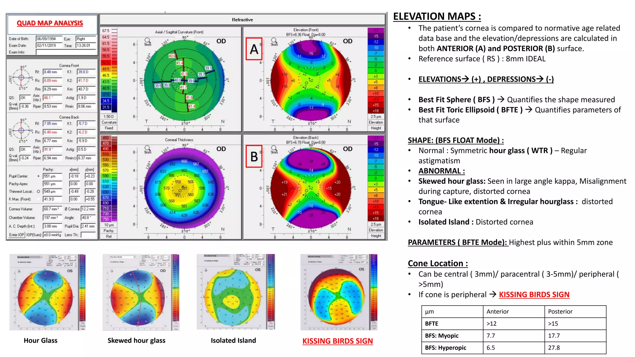Pentacam analysis | PPTX
